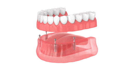 The Implant-Retained Denture Process | Brent Bradford, DDS